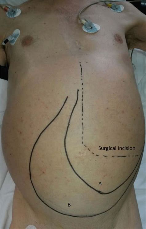 Splenic Artery Embolization For Massive Splenomegaly