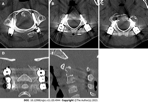 Postoperative Computed Tomography Of The Atlantoaxial Joint The Download Scientific Diagram Postoperative Computed Tomography Of The Atlantoaxial Joint The Download Scientific Diagram