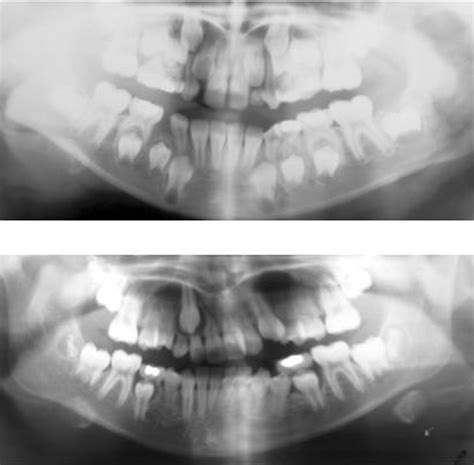 Female Patient Less Severe Ectopic Eruption And Only Diminutive