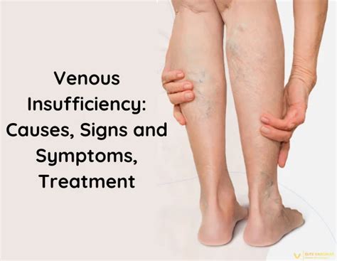 Venous Insufficiency Causes Signs Symptoms And Treatment Elite
