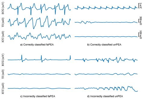 Pulseless Electrical Activity Ecg