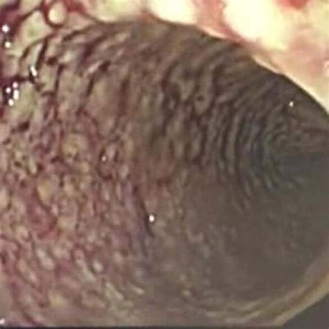 Endoscopic Examination Shows Mucosal Hyperemia Disappearance Of