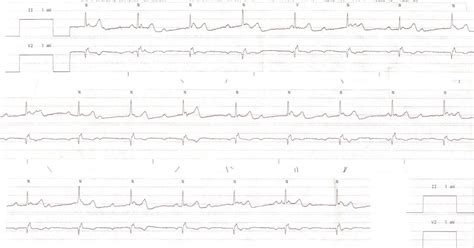 Dr Smith S Ecg Blog Intermittent Third Degree Heart Block Due To