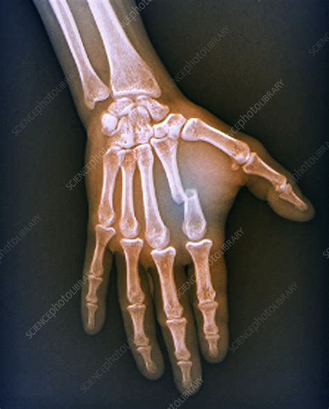 Broken Metacarpal X Ray