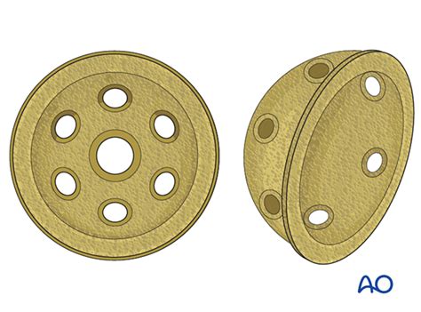 Orif Of Transverse Fractures For Intraoperative Acetabular Fracture During Insertion Not