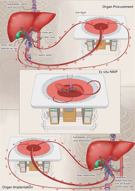 Liver Transplant Diagram