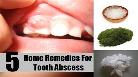 Tooth Abscess Homeopathic Treatment