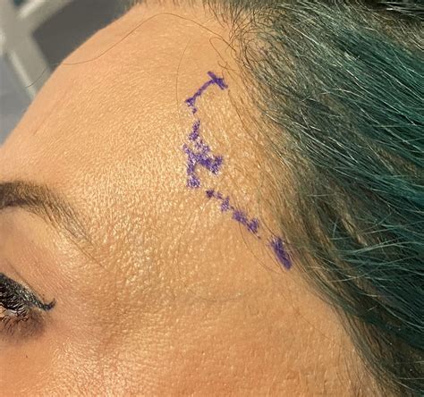 Left Temporla Artery Ligation Markings Dr Barry Eppley Explore Plastic Surgery