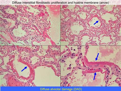 Diffuse Alveolar Damage Ppt
