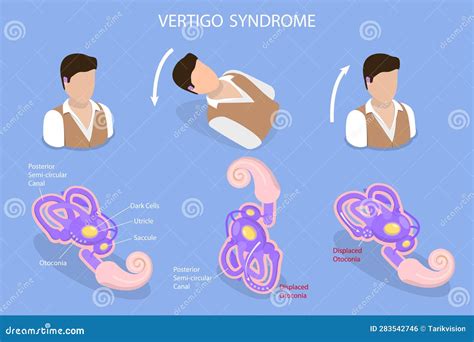 Bppv Cartoons Illustrations And Vector Stock Images 32 Pictures To