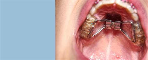 Orthodontic Expander A Key Tool For A Healthier Smile In Palo Alto Twin Smiles Orthodontics
