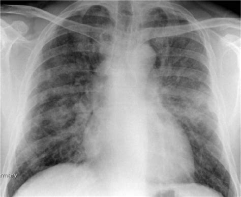 What Does Opacity Mean In Chest X Ray At Brodie Bolden Blog