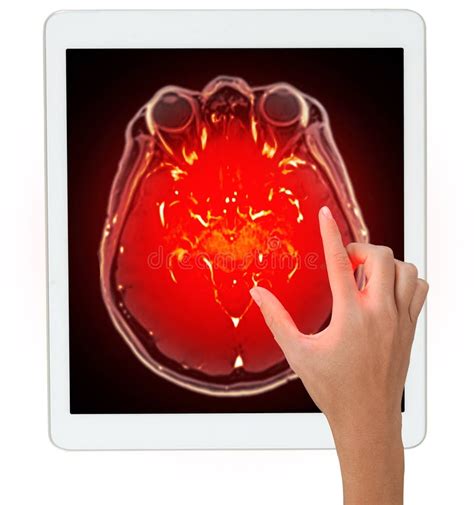 A Hand Touches A Tablet Screen Displaying A Brightly Highlighted Mri Brain Scan Focusing On The