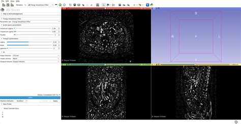 3d Slicers Liver Segmentation A Look At The New Features