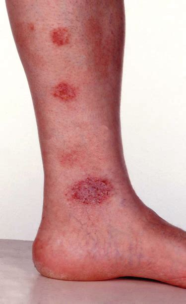 Eczema Dermatitis Plastic Surgery Key