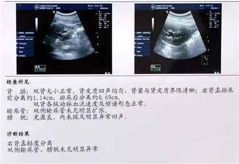 肾b超图怎么看图解 b超图怎么看 怎样看懂肾结石b超图 大山谷图库