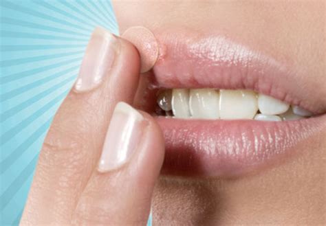 How To Treat A Fever Blister Herpatch Remesense