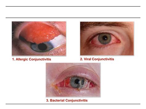 Conjunctivitis 200105121616 1 Pptx