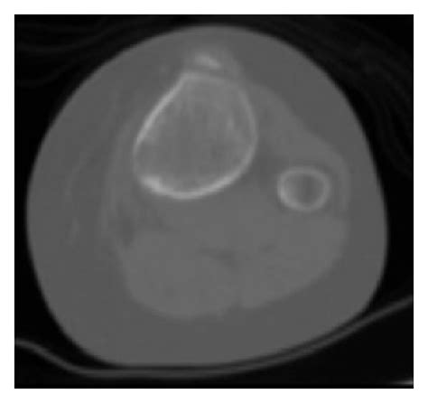 11 Year Old Patient With Tibia Metastasis Of A Femoral Osteosarcoma