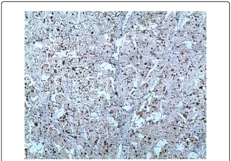 Tumor Cells Showing High Mitotic Index Download Scientific Diagram