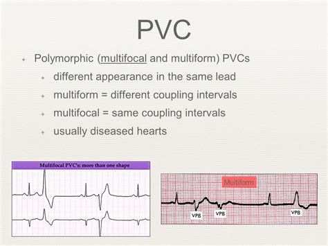 Ecg Interpretation Criteria Review Ppt Video Online Download