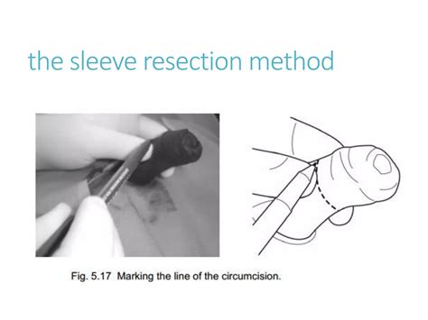 Basic Technique Of Circumcision By Regi Septian Ppsx