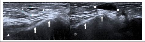 Figure 1 From Cystic Degeneration Of An Atypical Adventitial Bursitis Case Report And
