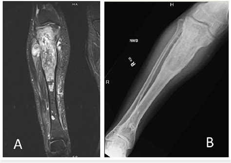 Mri A And Radiograph B Of The Tibia Mri Magnetic Resonance