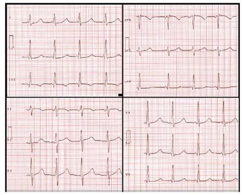 Prolonged Pr Interval