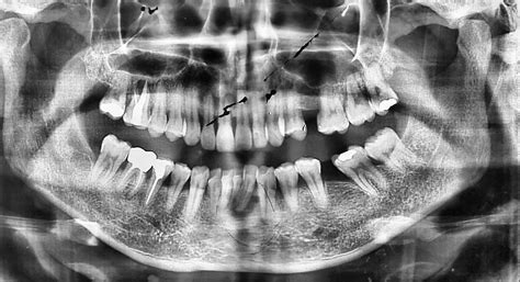 Caries Dental Class Dataset 3 Computer Vision Dataset By Fractured Teeth Dataset 3