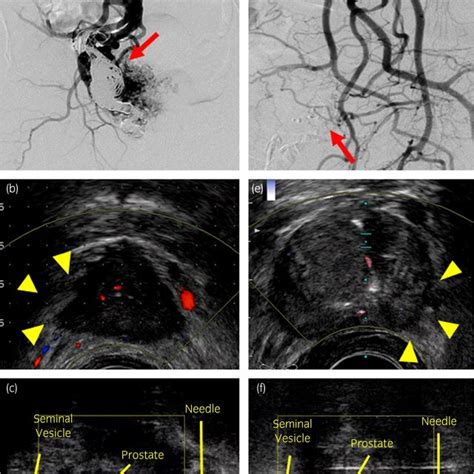 Images Showing Transcatheter Embolization Of A Pavm Performed To Lower