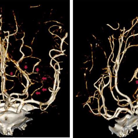 Head Cta Showed Suspected Deep Small Avm With Feeding Artery From The Download Scientific