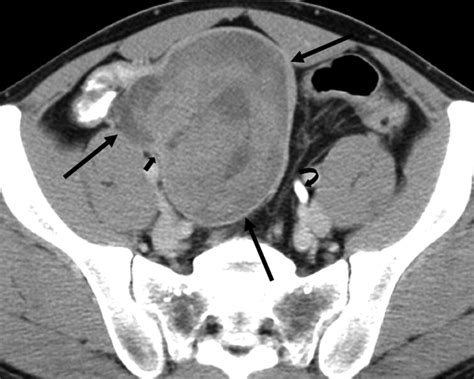 Radiologic Findings Of Peripheral Primitive Neuroectodermal Tumor Arising In The Retroperitoneum