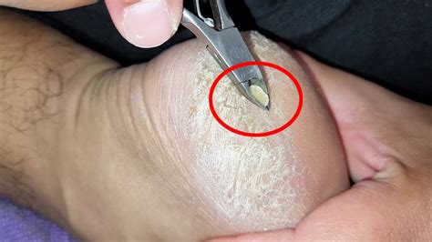 ASMR Surgery to Remove Plantar remove calluses and corns 딱딱하게 굳고 갈라진