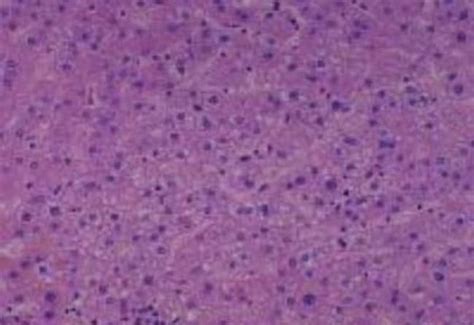 Novus Biologicals Human Liver Tissue Microarray Cancer Metastasis