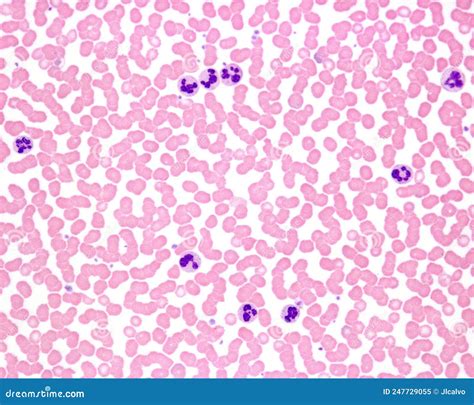 Human Blood Smear Leukocytosis Stock Image Image Of Leukocytosis