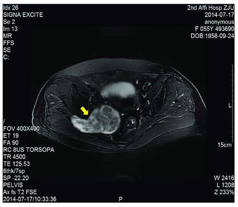T2 Weighted Image Showed A Right Sacral Mass As A Dumbbell Shaped Download Scientific Diagram
