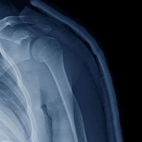 Proximal Humerus Fracture Fixation Shoulder Surgeon South Windsor Rocky Hill Glastonbury CT
