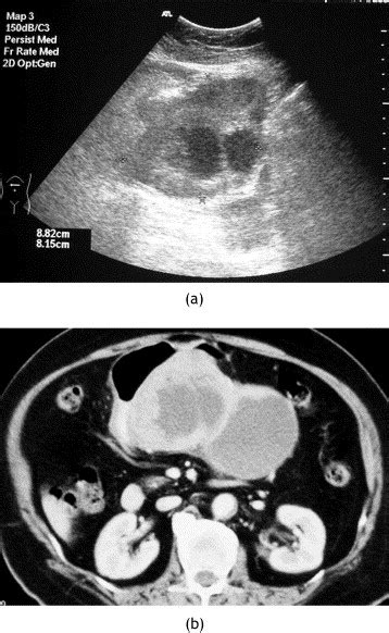 Imaging Of Gastrointestinal Stromal Tumour Gist Clinical Radiology