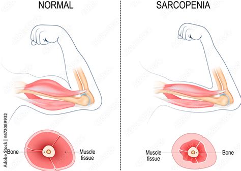 Sarcopenia Muscle Loss Stock Vector Adobe Stock