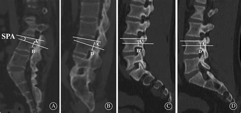 Pedicle Morphology Of Lower Thoracic And Lumbar Spine In Ankylosing