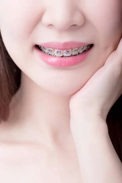 Asian Braces Stock Photos Royalty Free Asian Braces Images Depositphotos