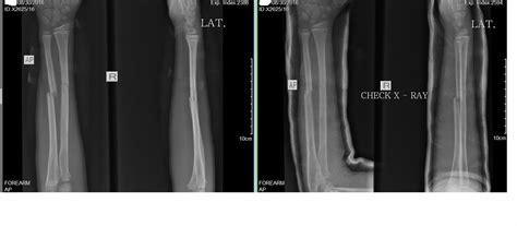 Both Bone Forearm Fracture Pediatric Pediatrics Orthobullets