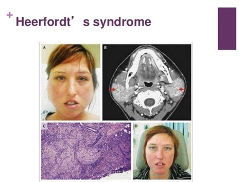 Diffuse Lung Disease Flashcards Quizlet
