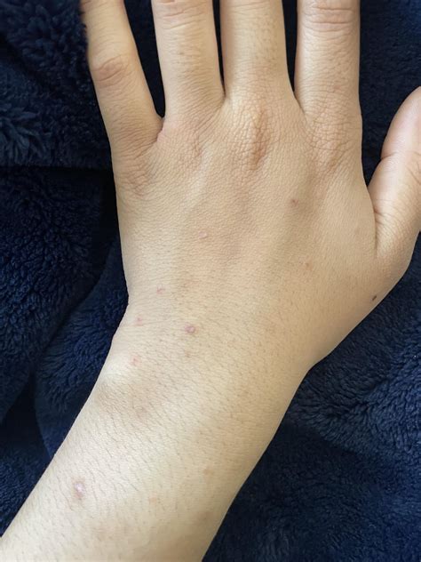 Bug Bite Scabs Scars R Bugbites