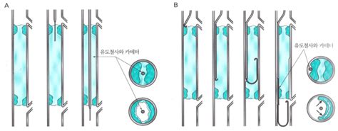 Pta 다리혈관치료 내막하혈관성형술 Subintimal Angioplasty 진강 True Lumen 혈관성형술과 비교 네이버 블로그