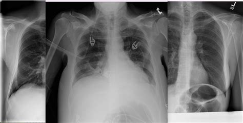multi categorical classification of chest x rays towards data science