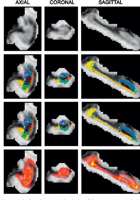 Figure 1 From Improved Inference In Bayesian Segmentation Using Monte Carlo Sampling