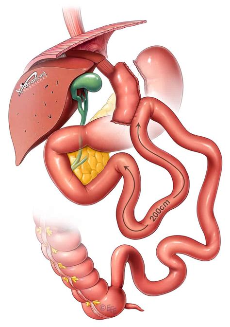 Omega Loop Gastric Bypass Sydney Advanced Surgicare