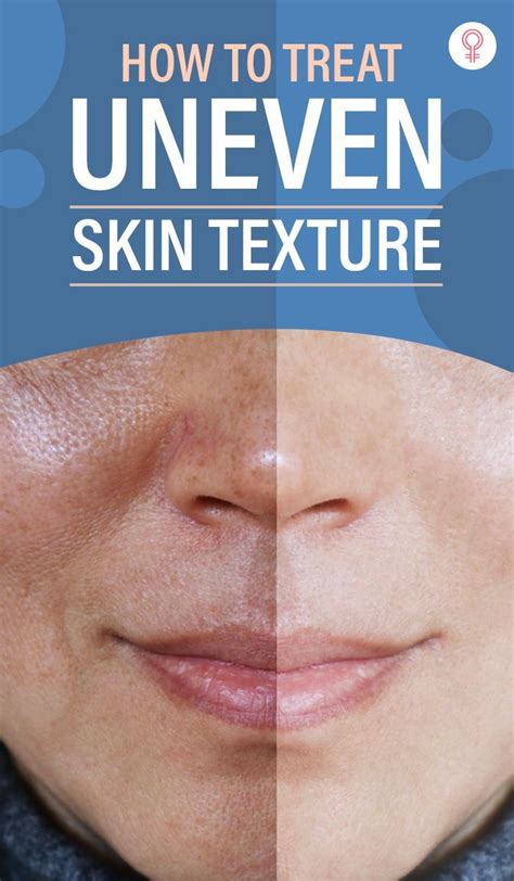Uneven Skin Texture Artofit